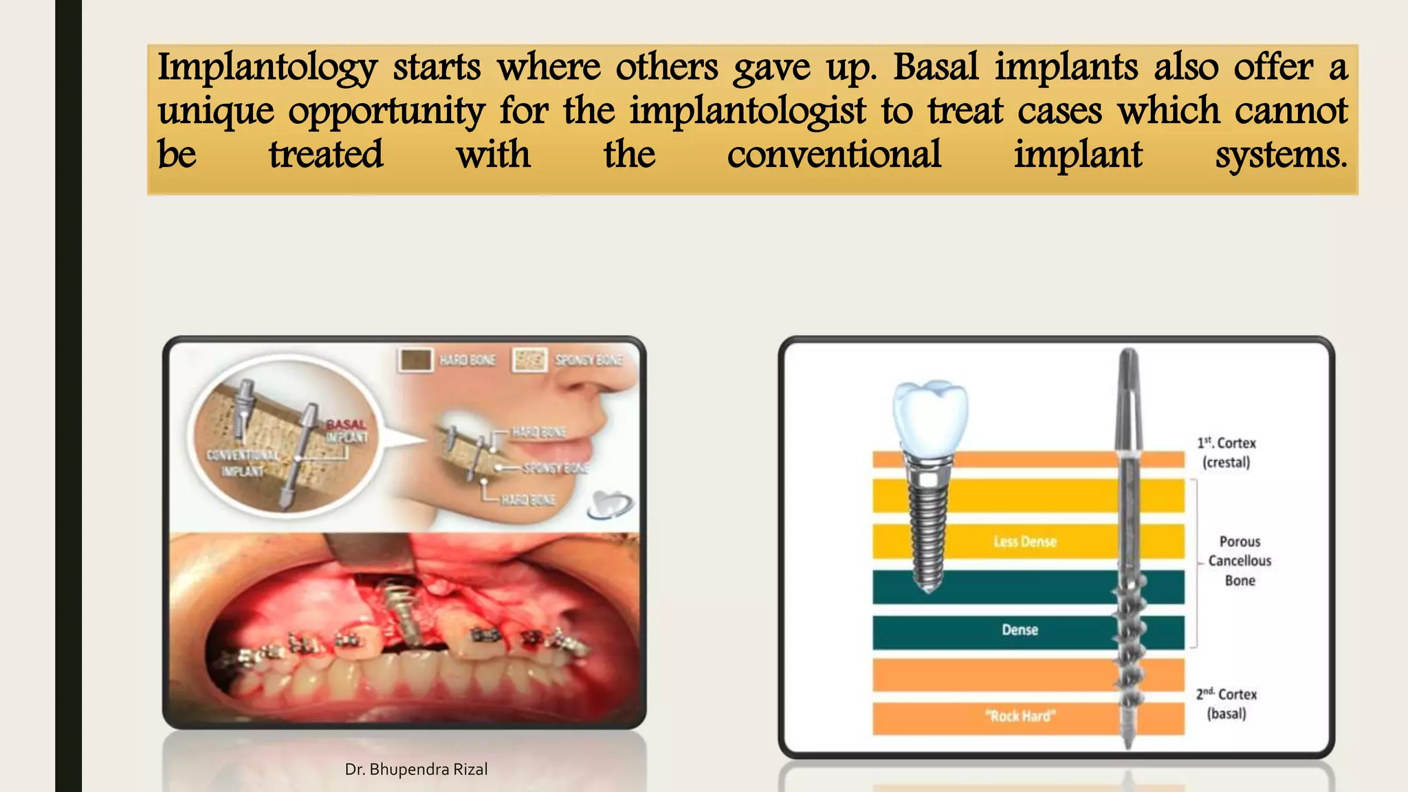 Basal implant - a newer variety of implant system | PPTX