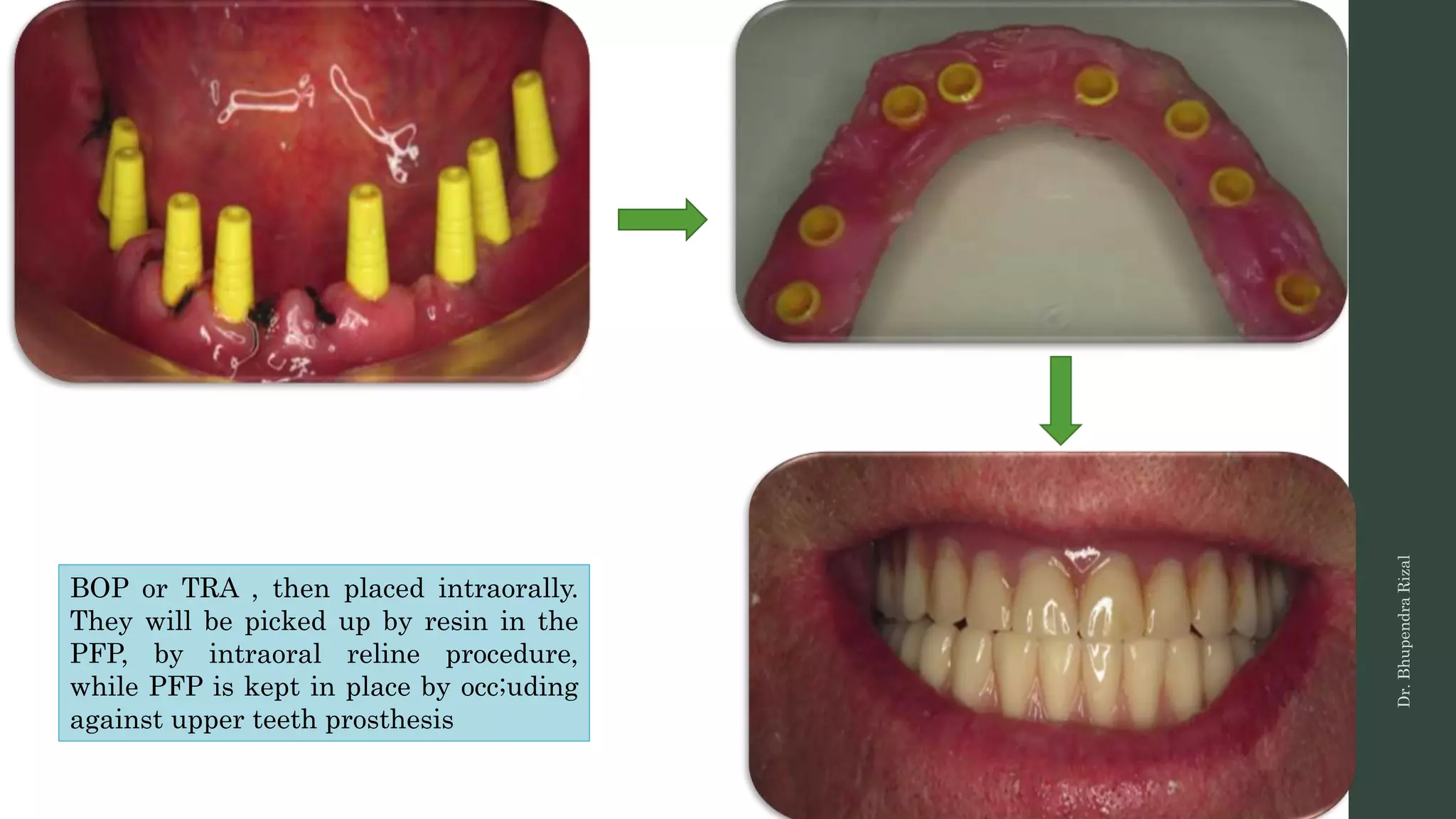 Basal implant - a newer variety of implant system | PPTX