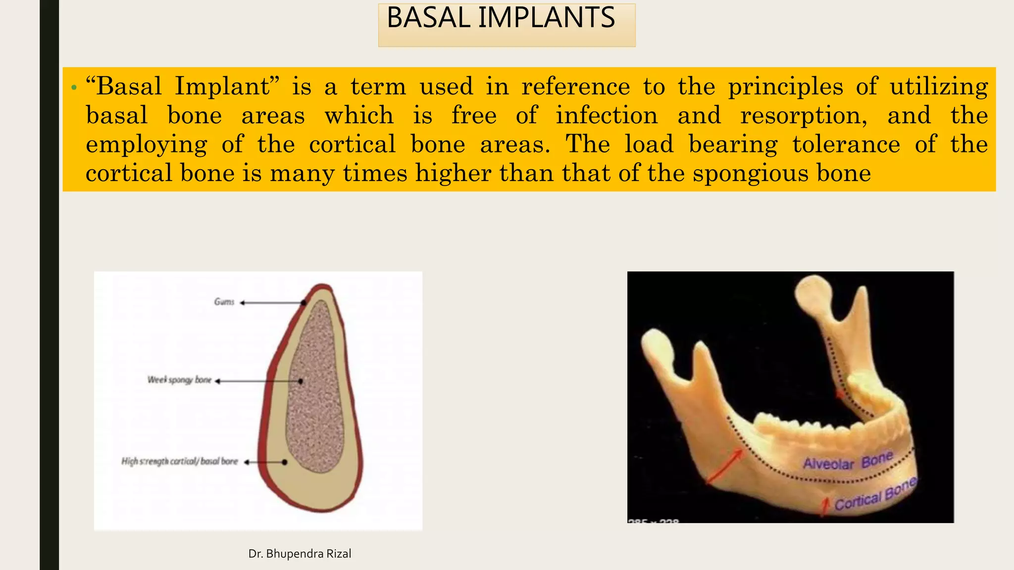 Basal implant - a newer variety of implant system | PPTX