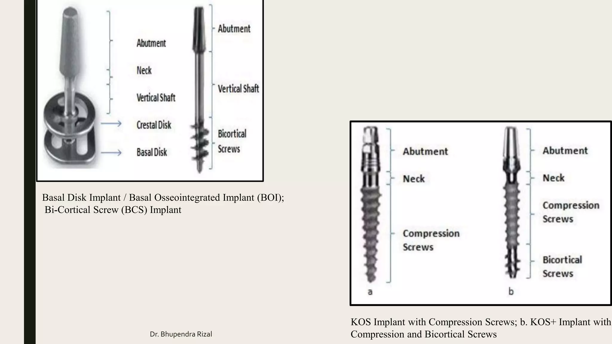 Basal implant - a newer variety of implant system | PPTX