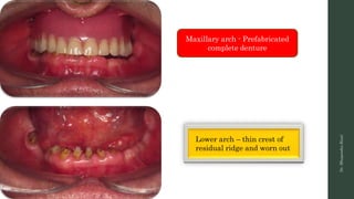 Basal implant - a newer variety of implant system | PPTX