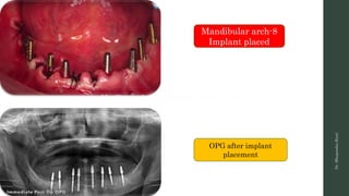 Basal implant - a newer variety of implant system | PPTX