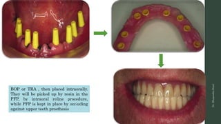 Basal implant - a newer variety of implant system | PPTX
