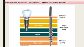 Basal implant - a newer variety of implant system | PPTX