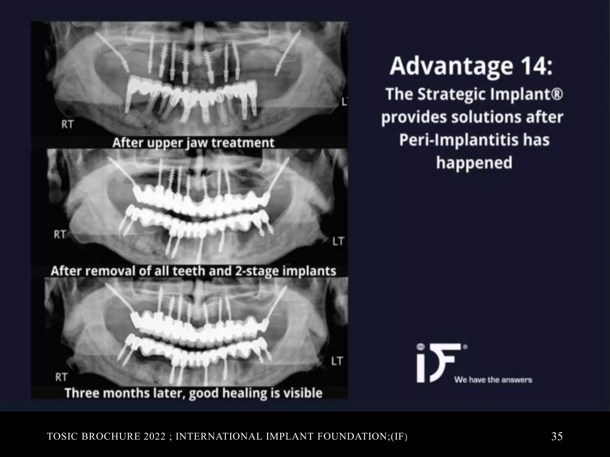 BASAL IMPLANTOLOGY gupta.pptx