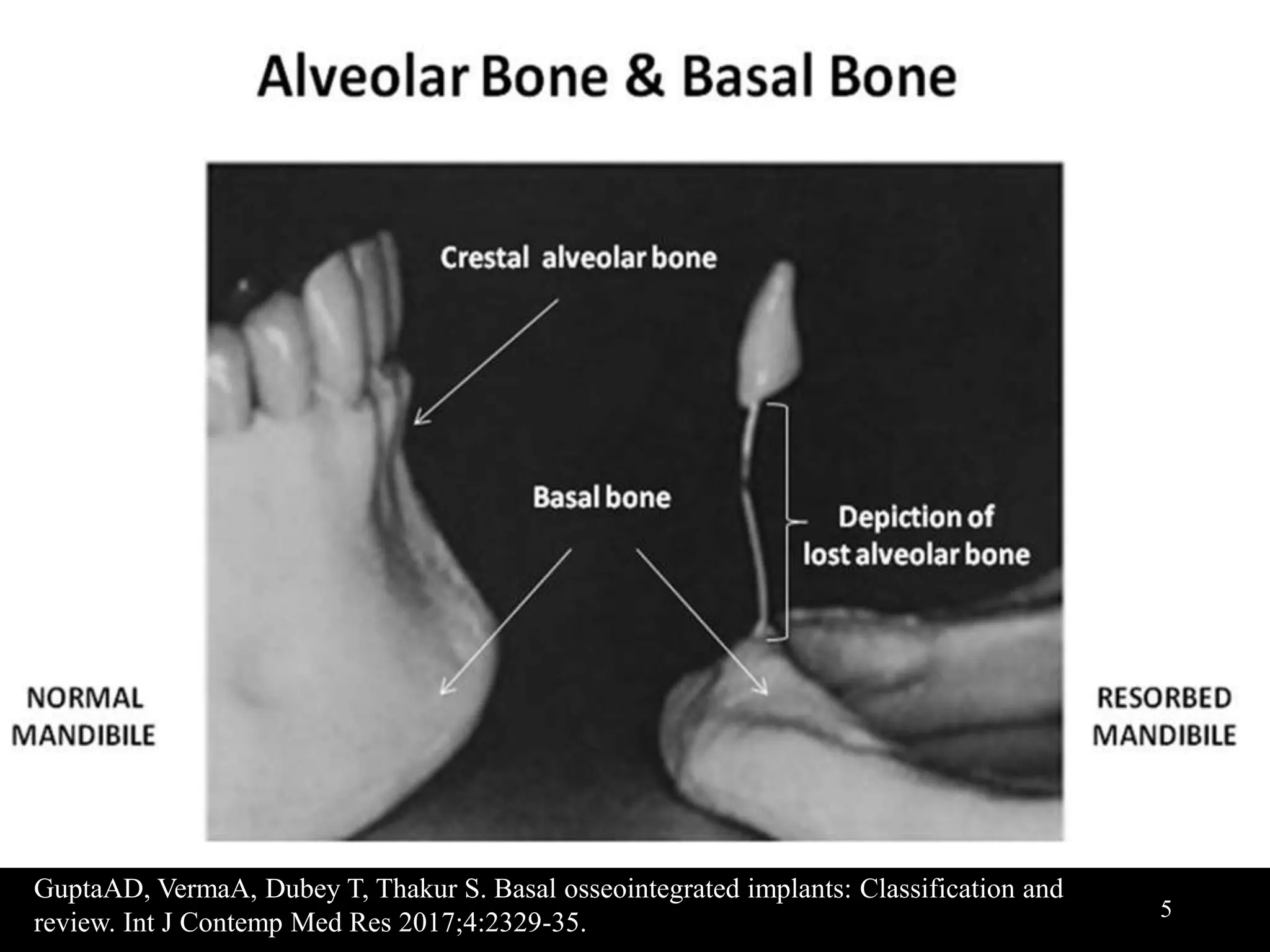 BASAL IMPLANTOLOGY gupta.pptx