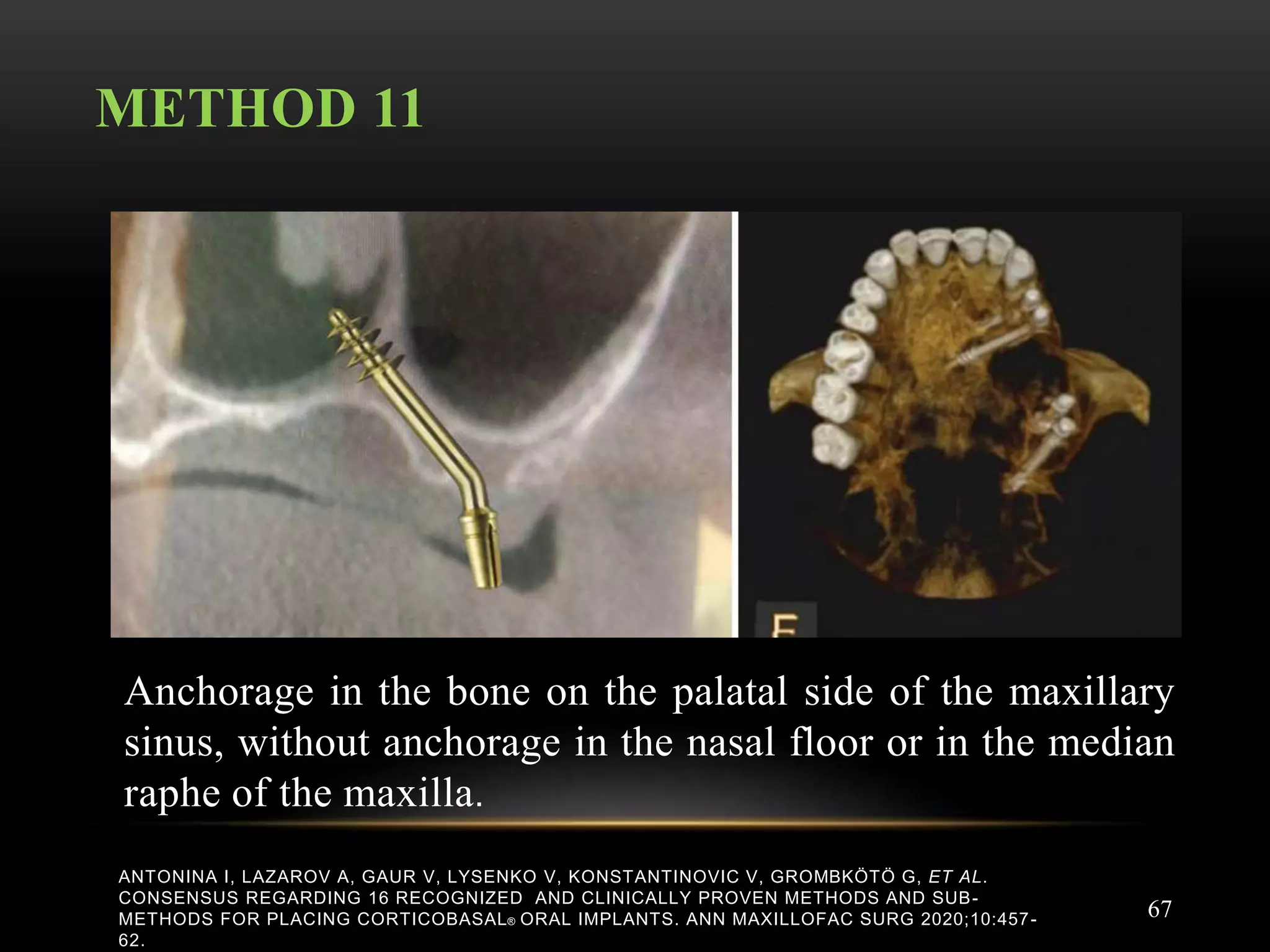 BASAL IMPLANTOLOGY gupta.pptx