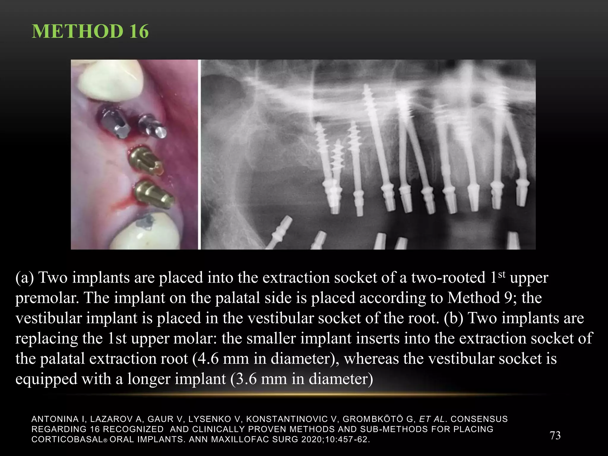 BASAL IMPLANTOLOGY gupta.pptx