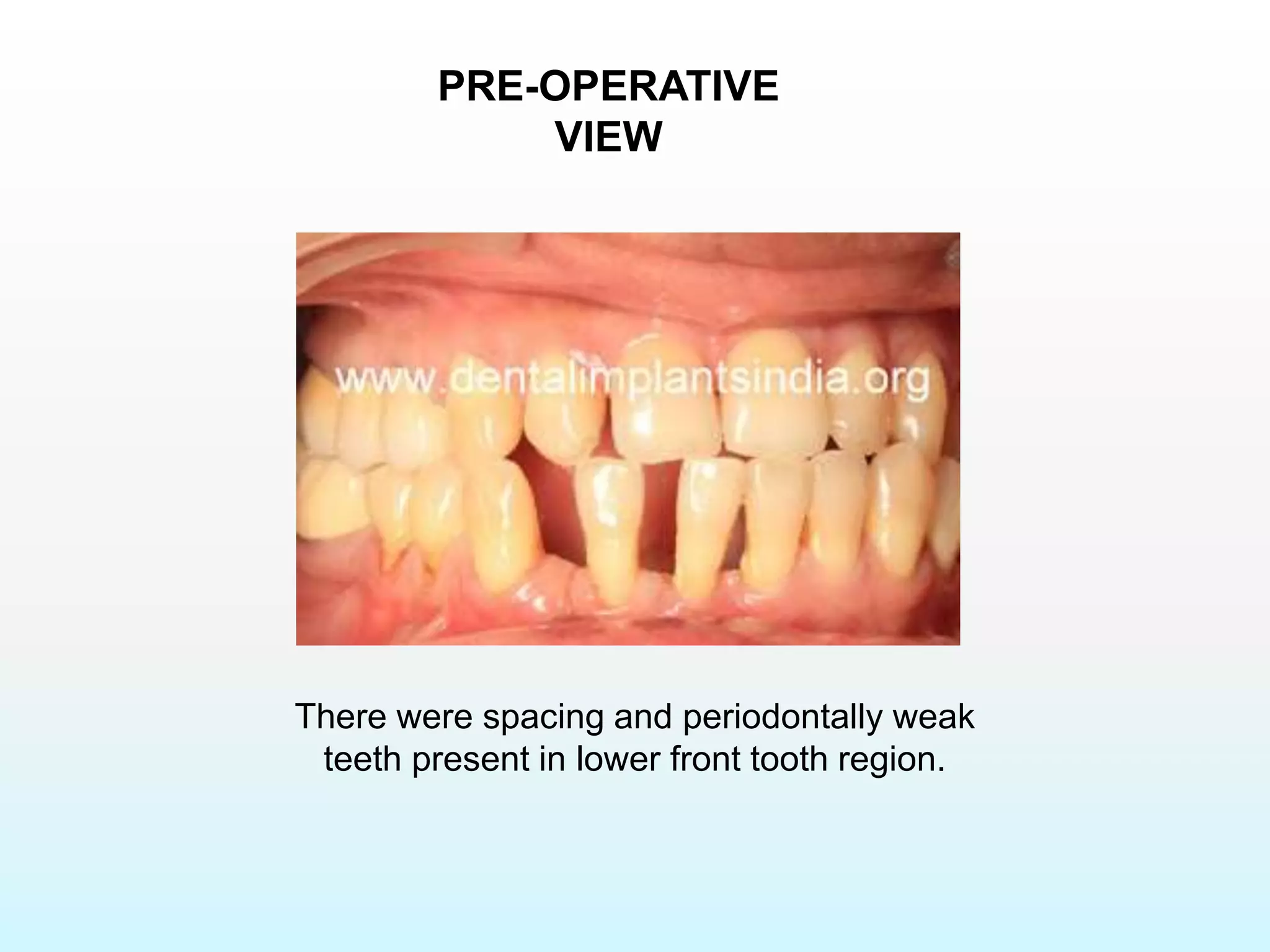 Basal implants without bone graft for the replacement of lower front ...