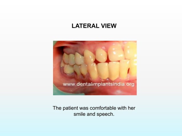 Basal implants without bone graft for the replacement of lower front ...