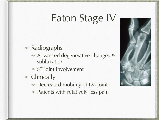 Basal joint arthritis presentation