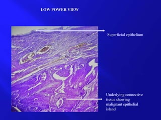 Basaloid squamous cell carcinoma seminar | PPTX