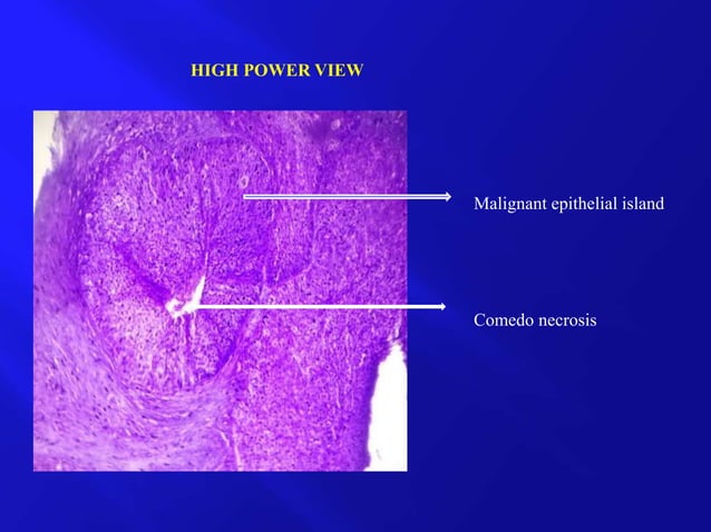 Basaloid Squamous Cell Carcinoma Seminar Ppt