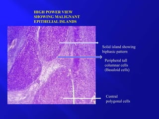 Basaloid squamous cell carcinoma seminar | PPT