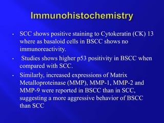 Basaloid squamous cell carcinoma seminar | PPT