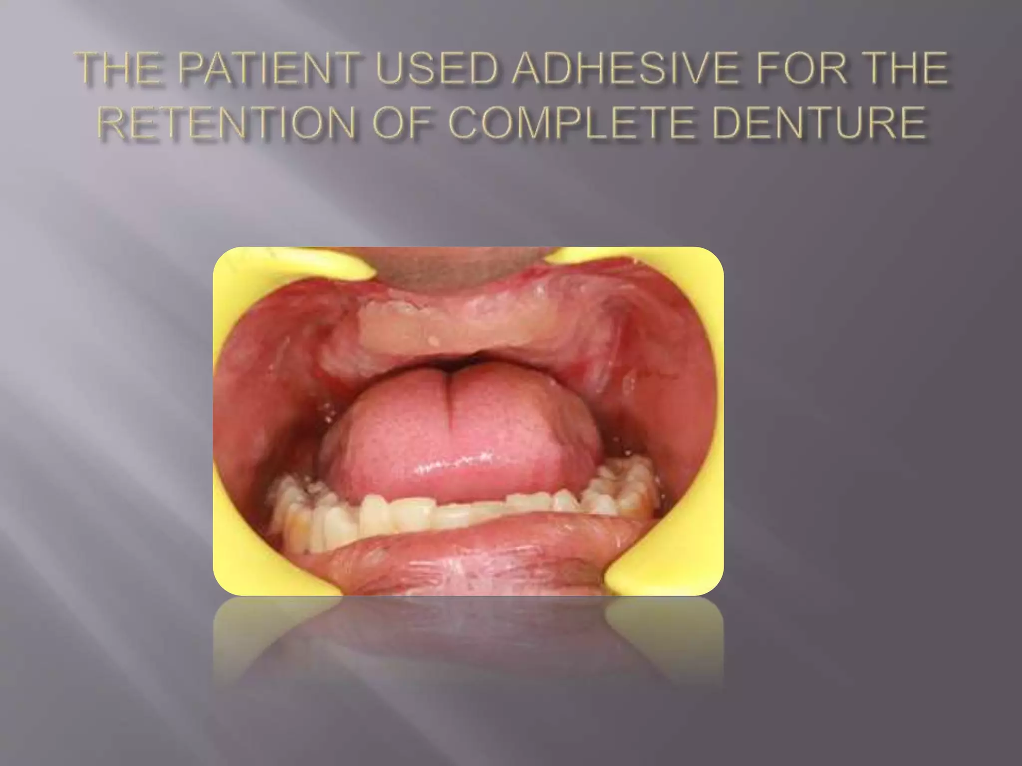 Basal Pterygoid Implants To Avoid Zygomatic Implants Ppt