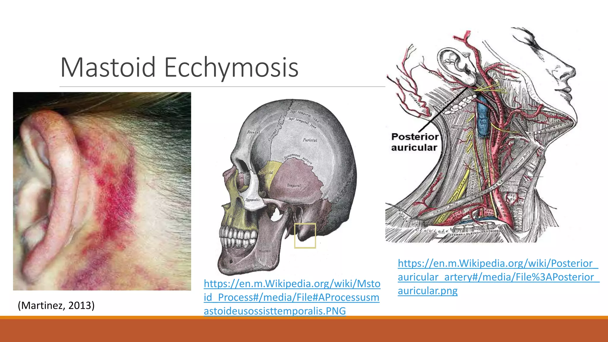 Basal skull fractures | PPTX