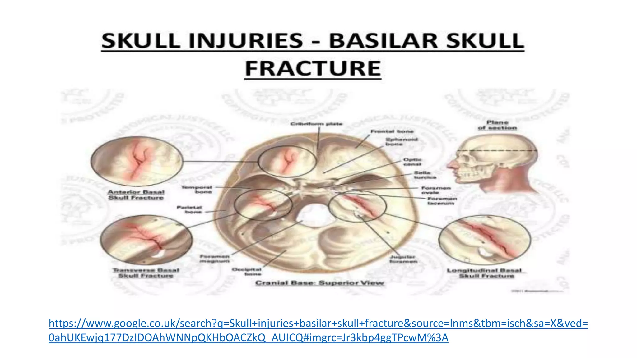 Basal skull fractures | PPTX