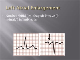 ECG BASICS IN DETAIL | PPT
