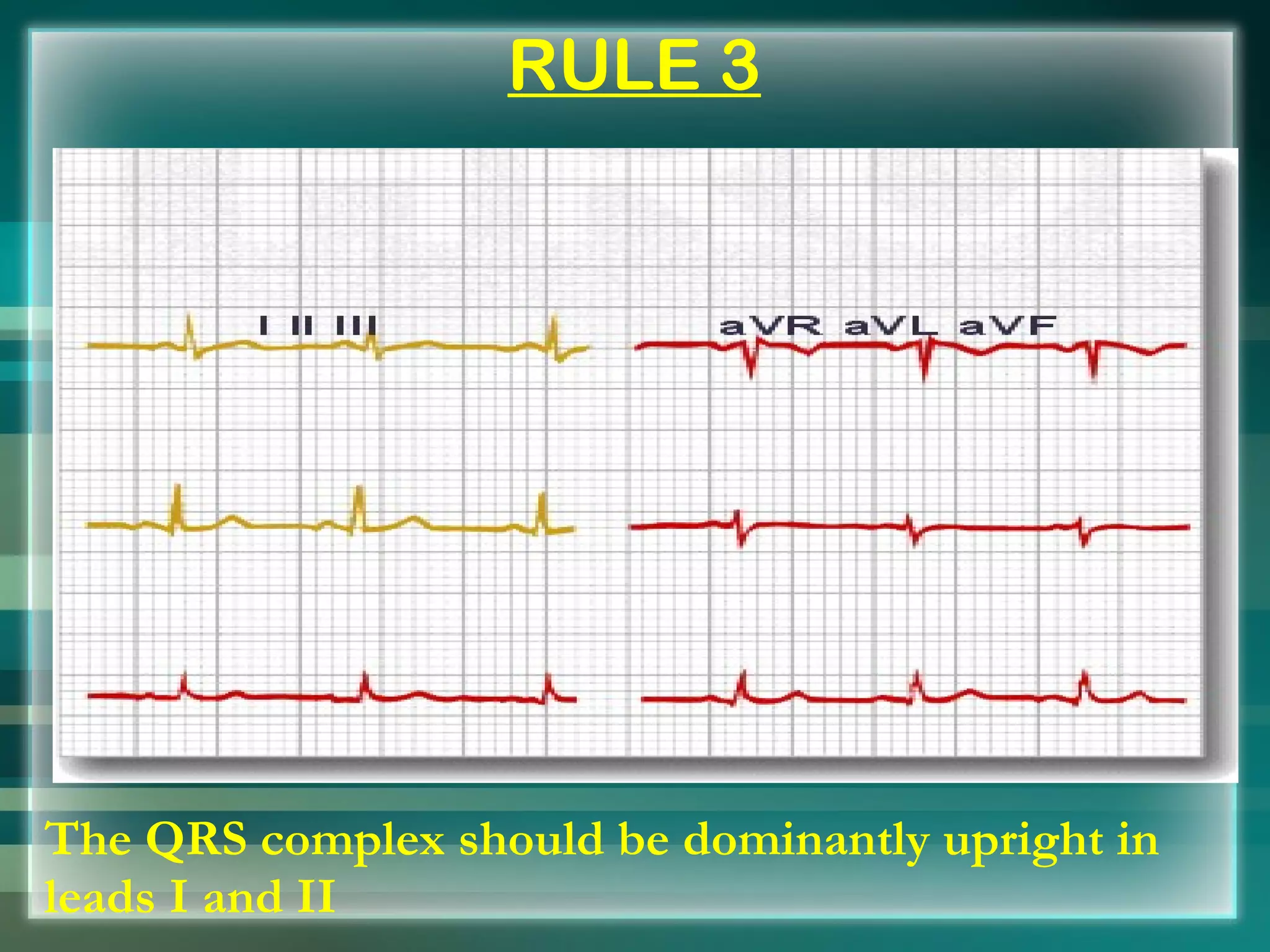 ECG Basics | PPT