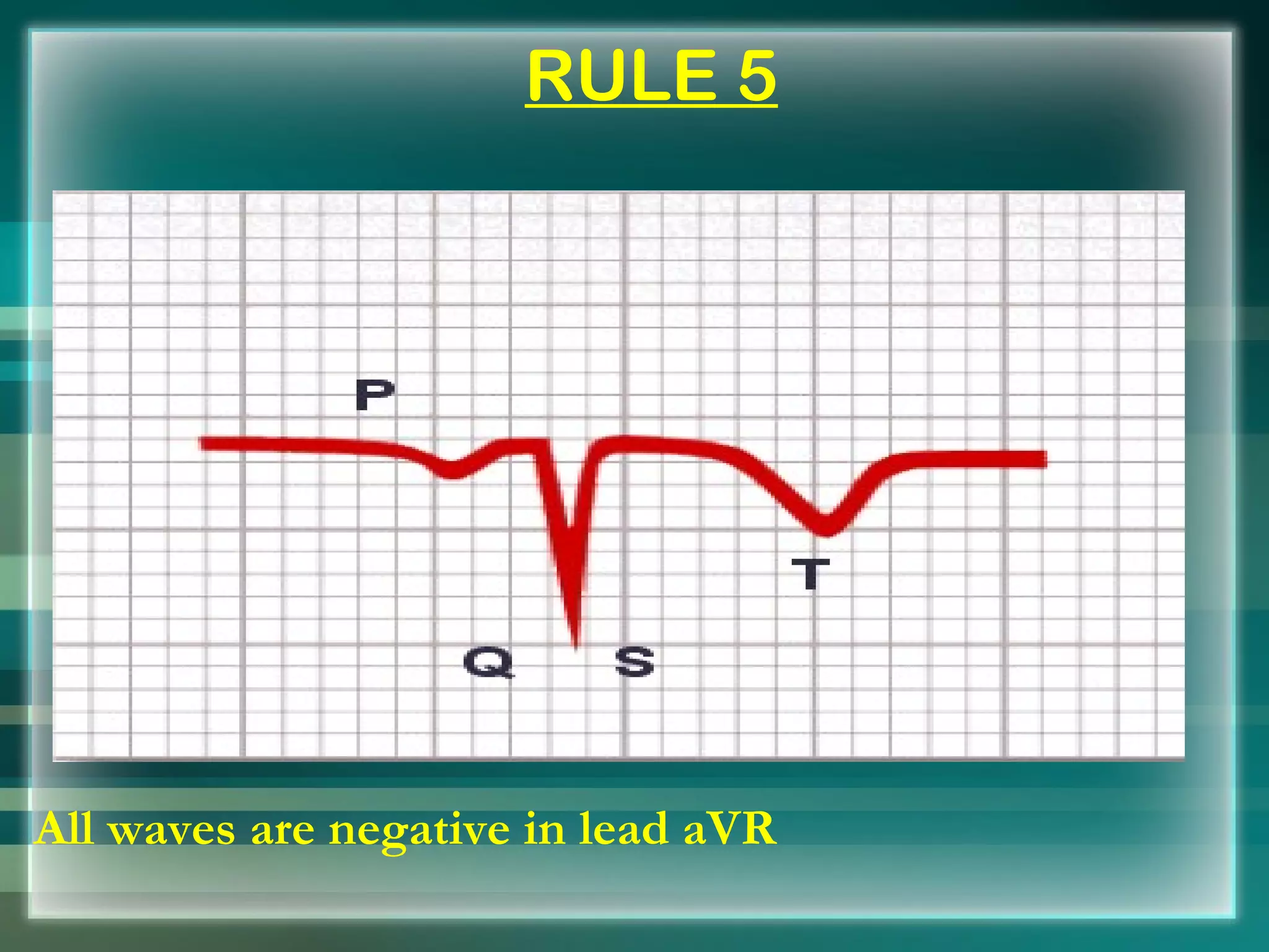 ECG Basics | PPT