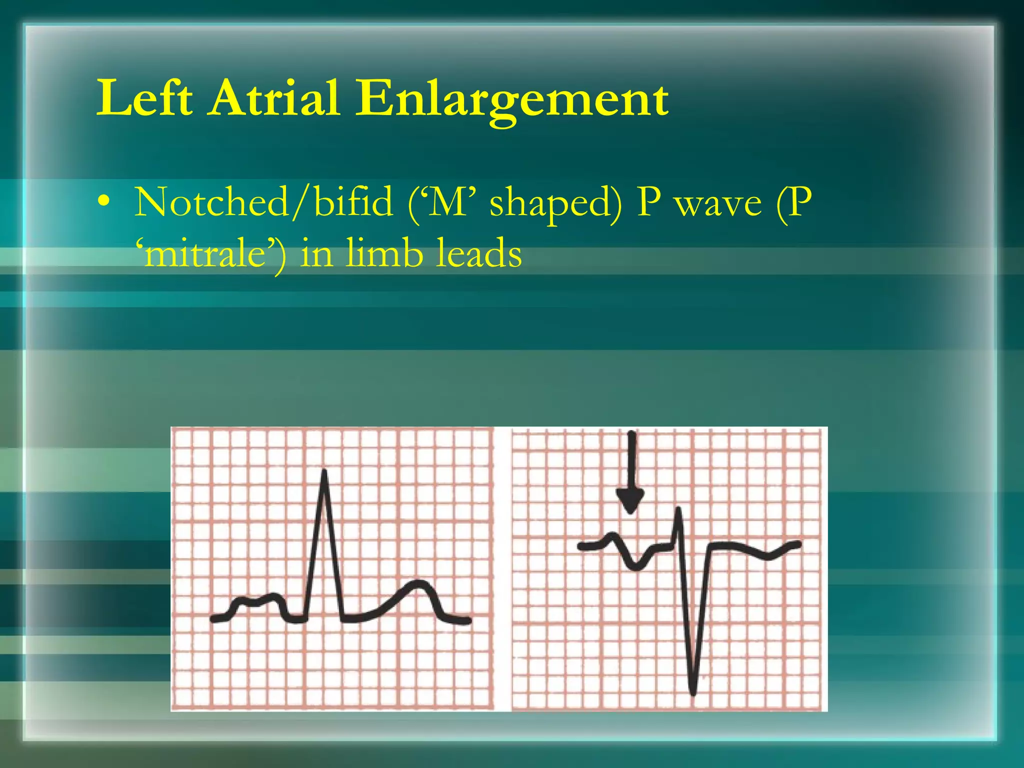 ECG Basics | PPT