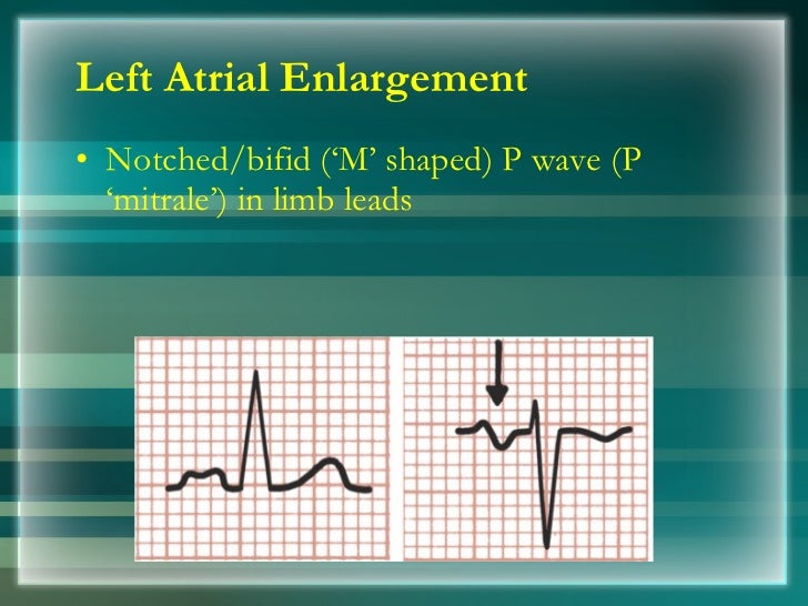 ECG Basics