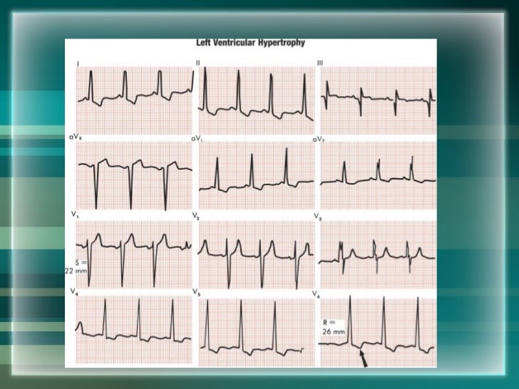 ECG Basics