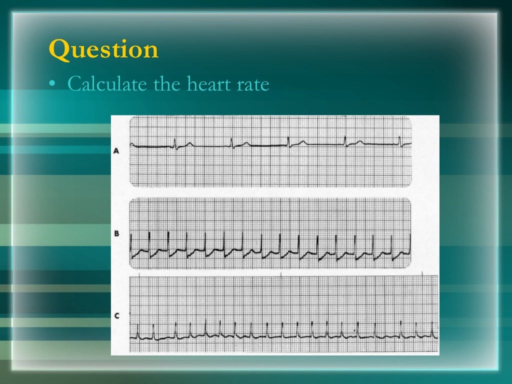 ECG Basics