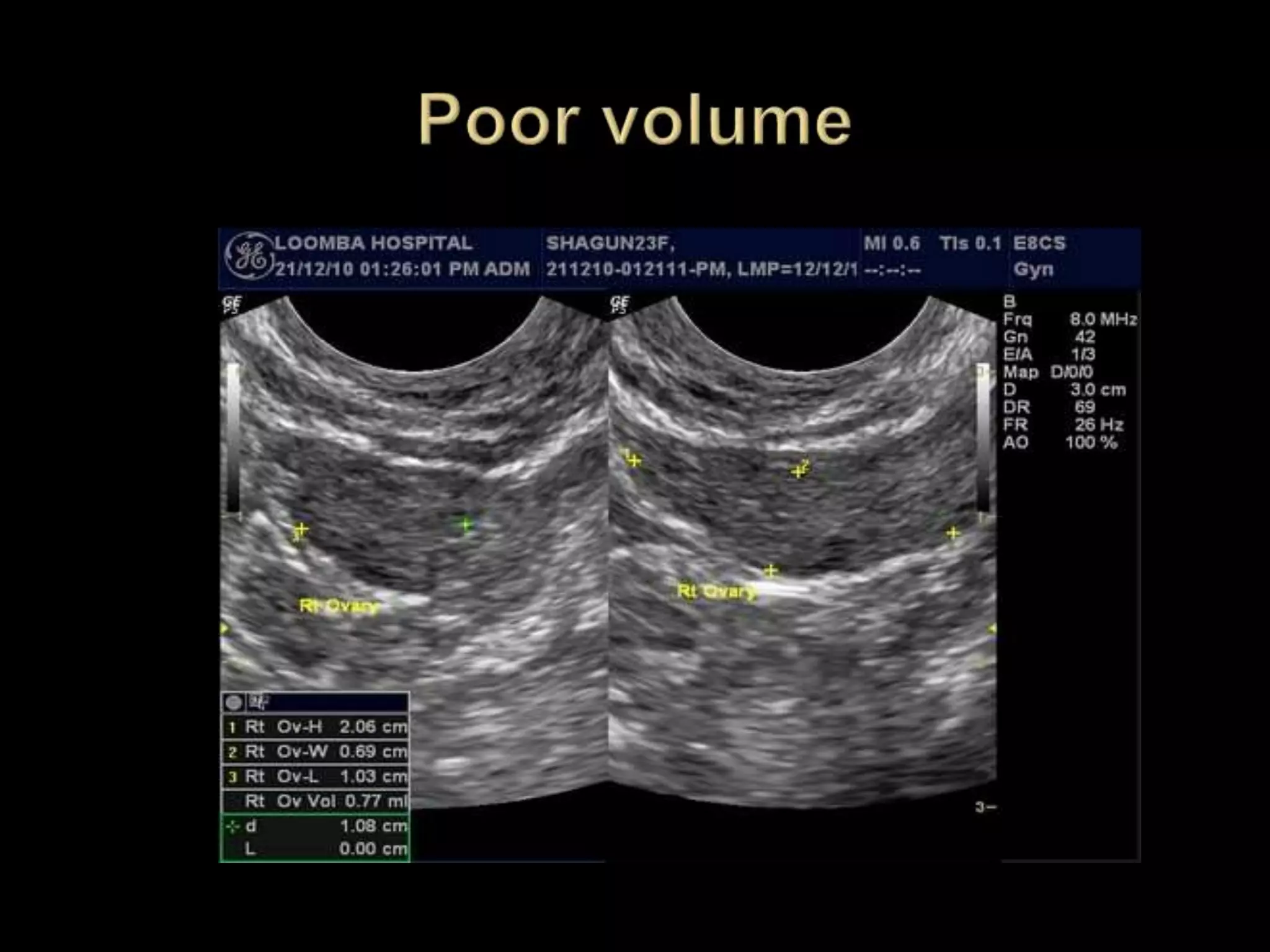 Baseline scan in infertility | PPT