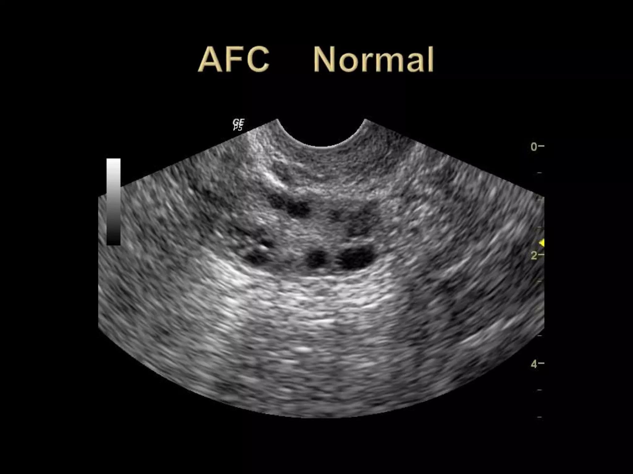Baseline scan in infertility | PPT