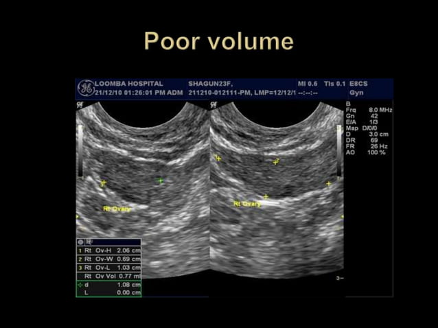 Baseline scan in infertility | PPT