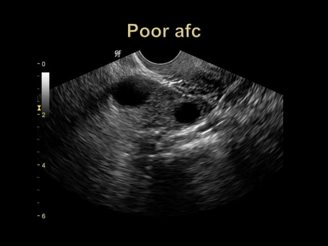 Baseline scan in infertility | PPT