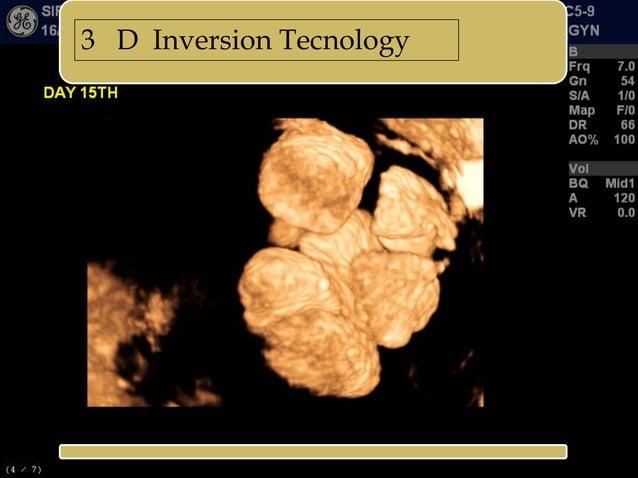 Baseline scan in infertility | PPT