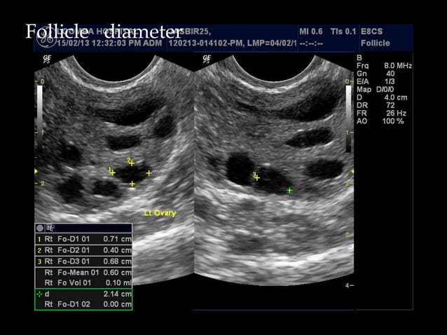 Baseline scan in infertility | PPT