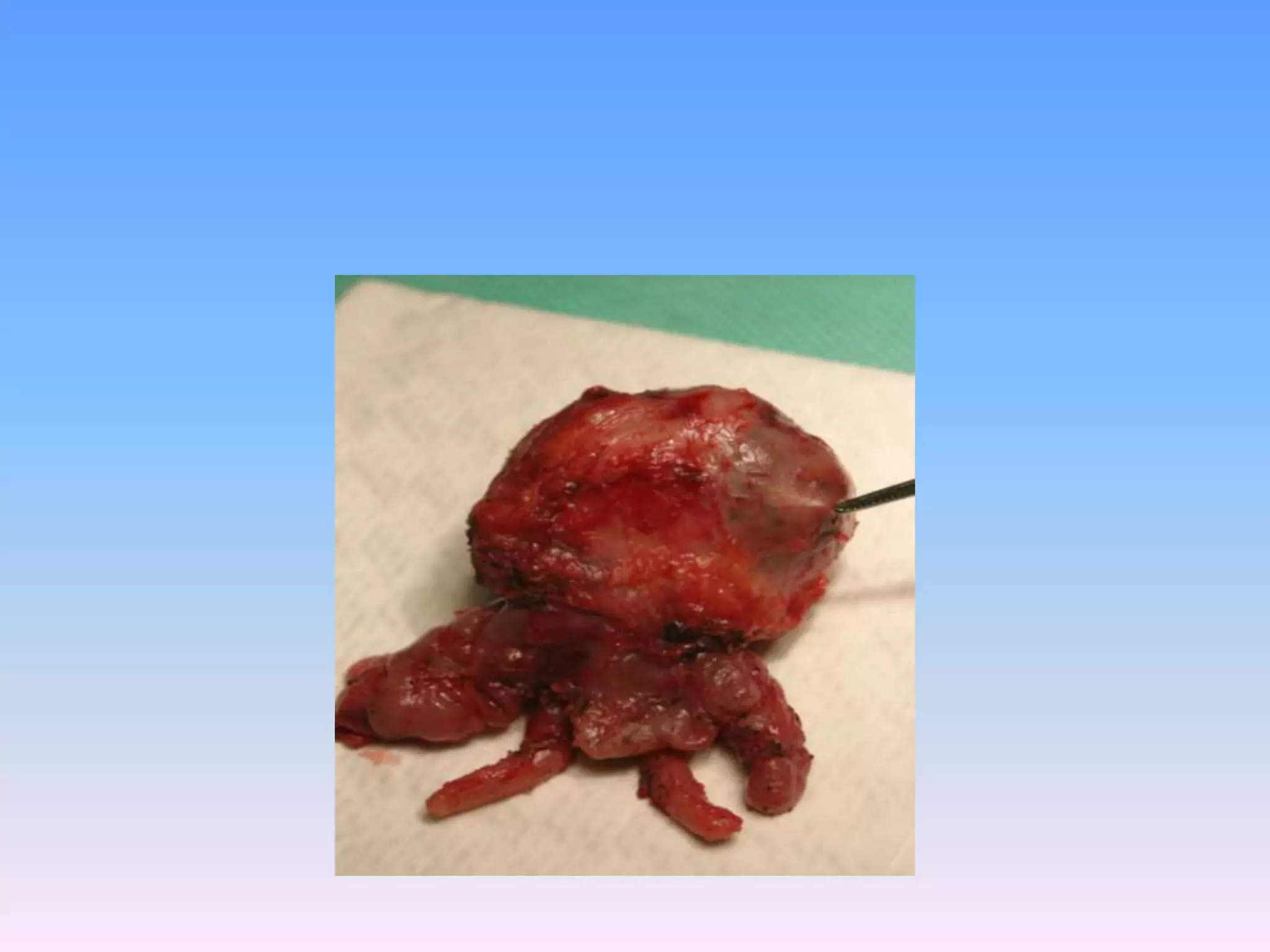 Base of prostate and lateral dissection + | PPTX
