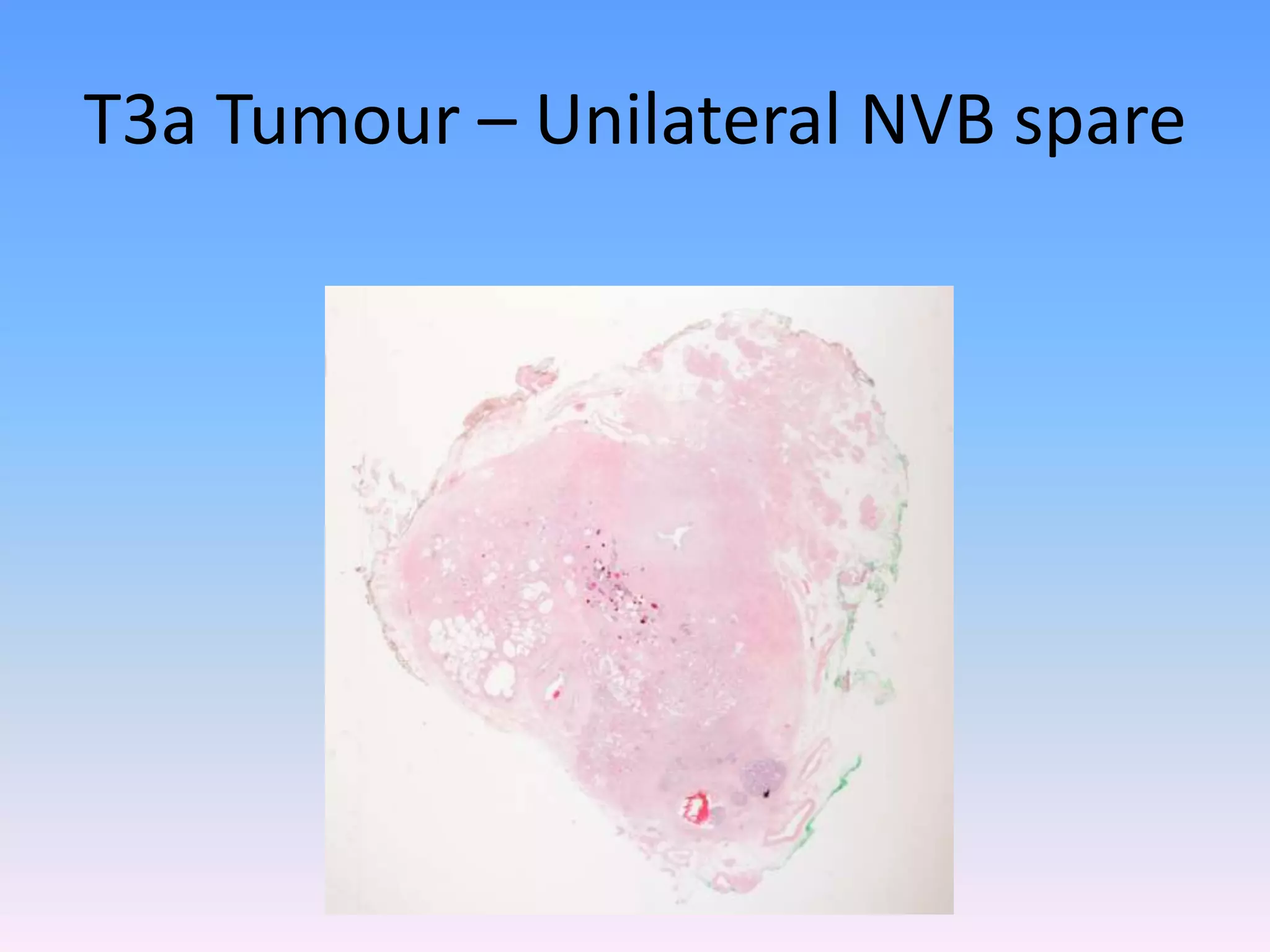 Base of prostate and lateral dissection + | PPTX