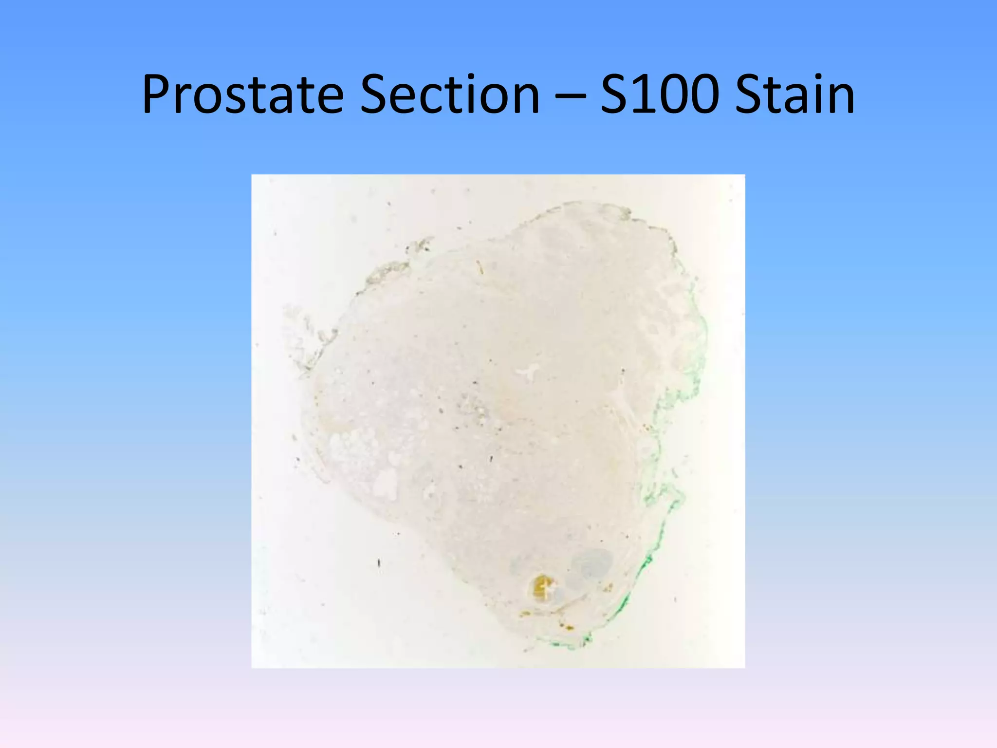 Base of prostate and lateral dissection + | PPTX