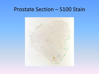 Base of prostate and lateral dissection + | PPTX