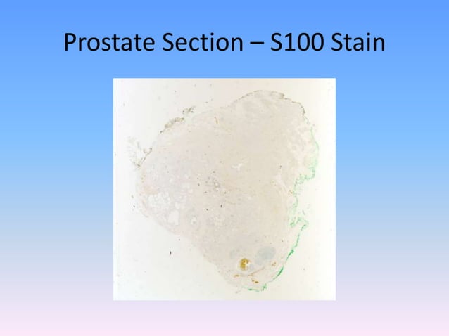 Base of prostate and lateral dissection + | PPTX