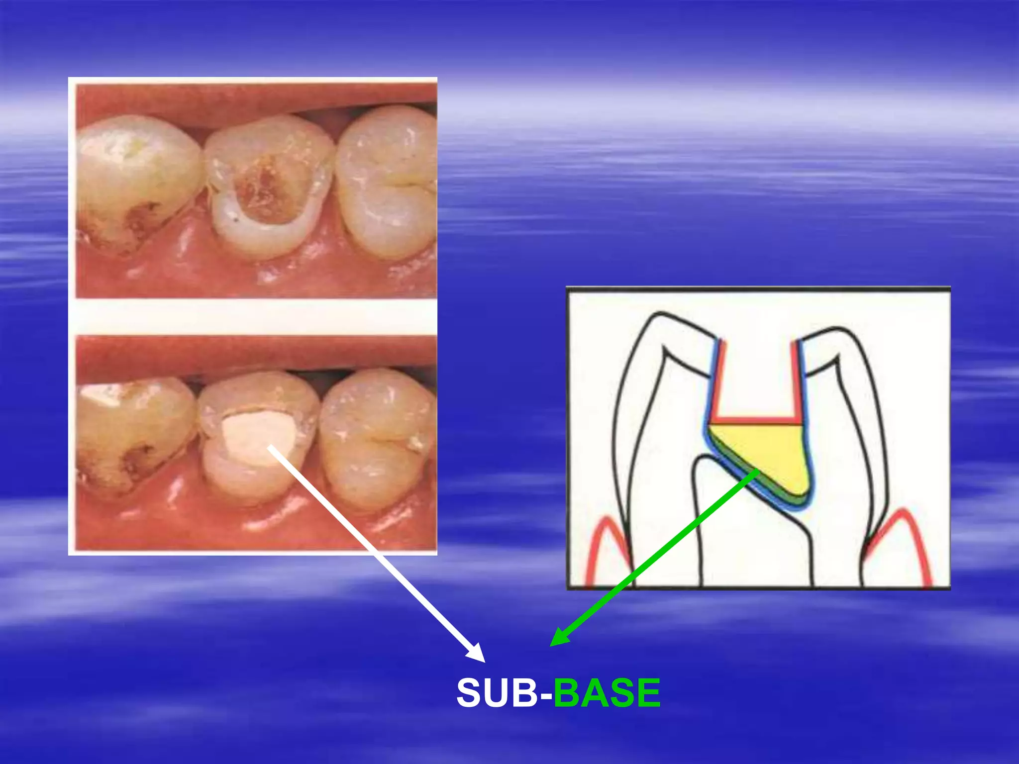 BASES AND LINERS IN OPERATIVE DENTISTRY.ppt