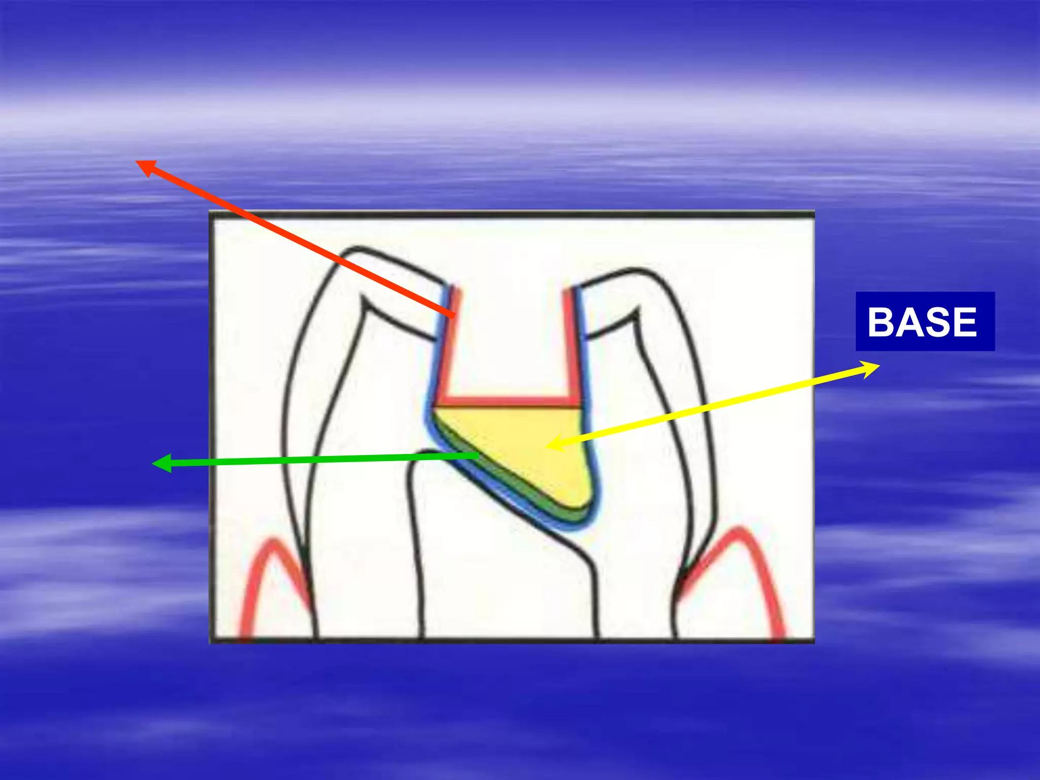 BASES AND LINERS IN OPERATIVE DENTISTRY.ppt