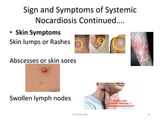 Systemic Nocardiosis | PPTX