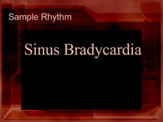 Basic Arrythmias | PDF