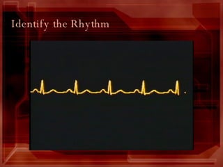 Basic Arrythmias | PPT