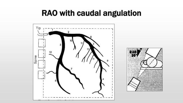 Basic-Coronary-Angiography_All-Slides.pdf | Heart and Cardiovascular ...