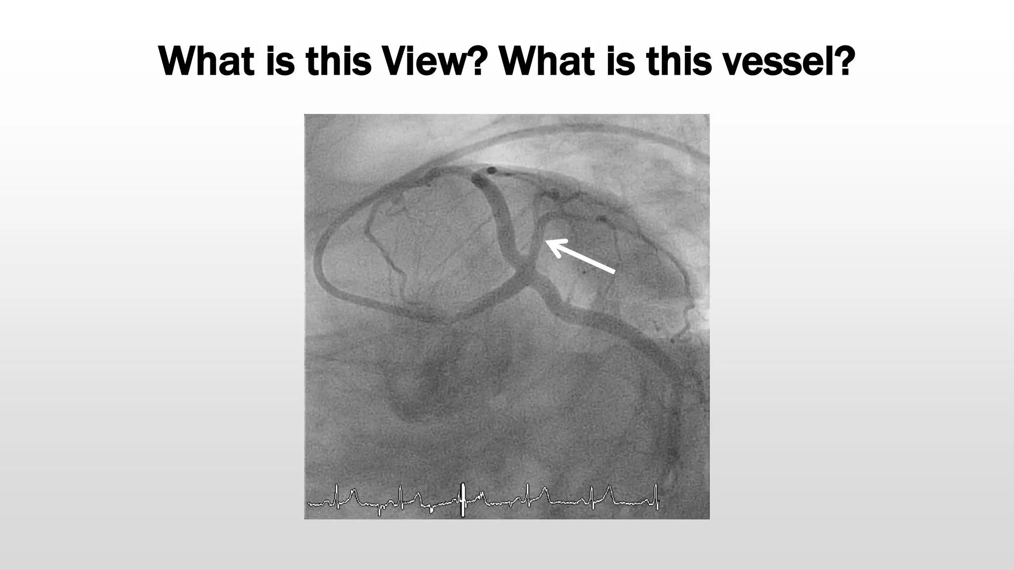 Basic Coronary Angiography All Slides Pdf