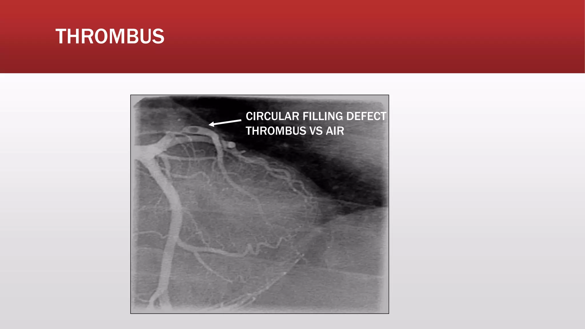 Basic-Coronary-Angiography_All-Slides.pdf