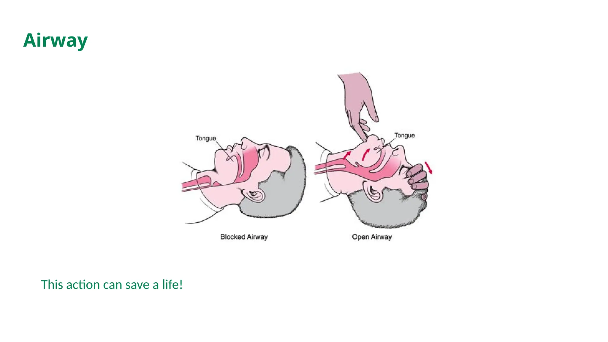 Basic--First-Aid--The Recovery--Position | PPT