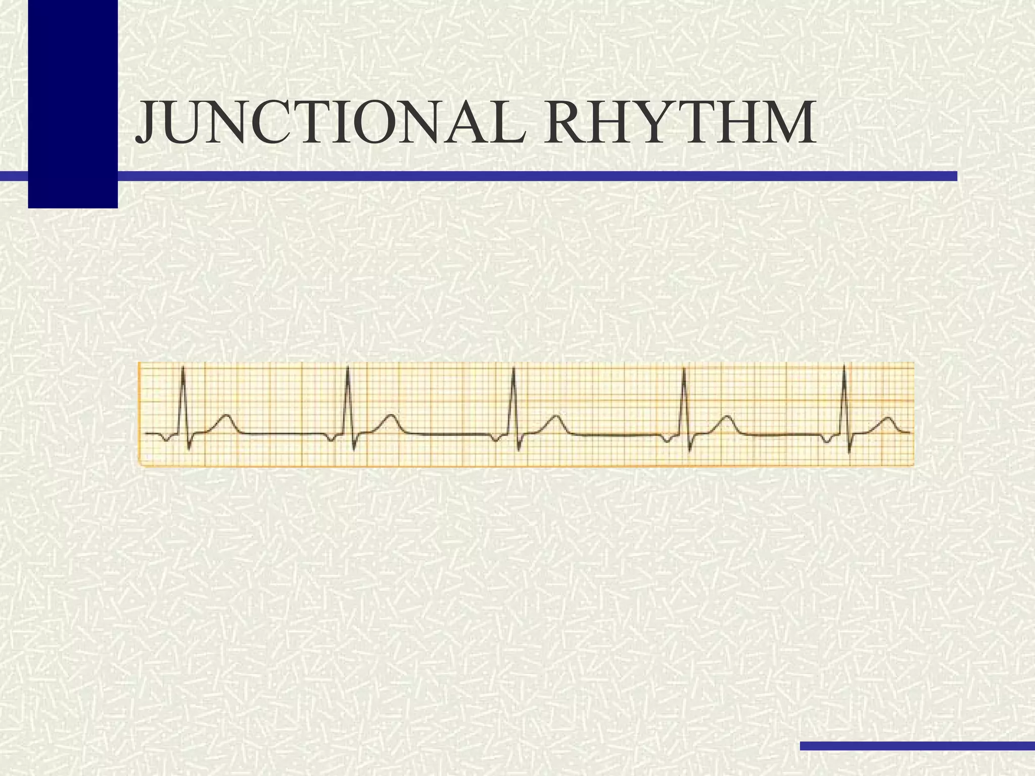 Basic Rhythm Strip Review | PPT
